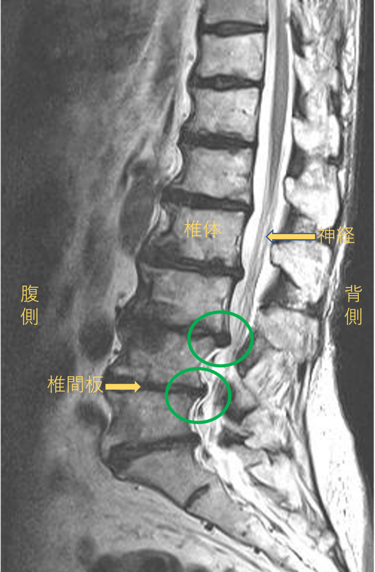 【PLDD法】1年ほど前より腰痛、両下肢のしびれがあり、足の冷えも強くなってきた80代女性【治療実績】 | 医療あれこれ日記 | 椎間板ヘルニアのレーザー治療 PLDD専門クリニック 伊東くりにっく