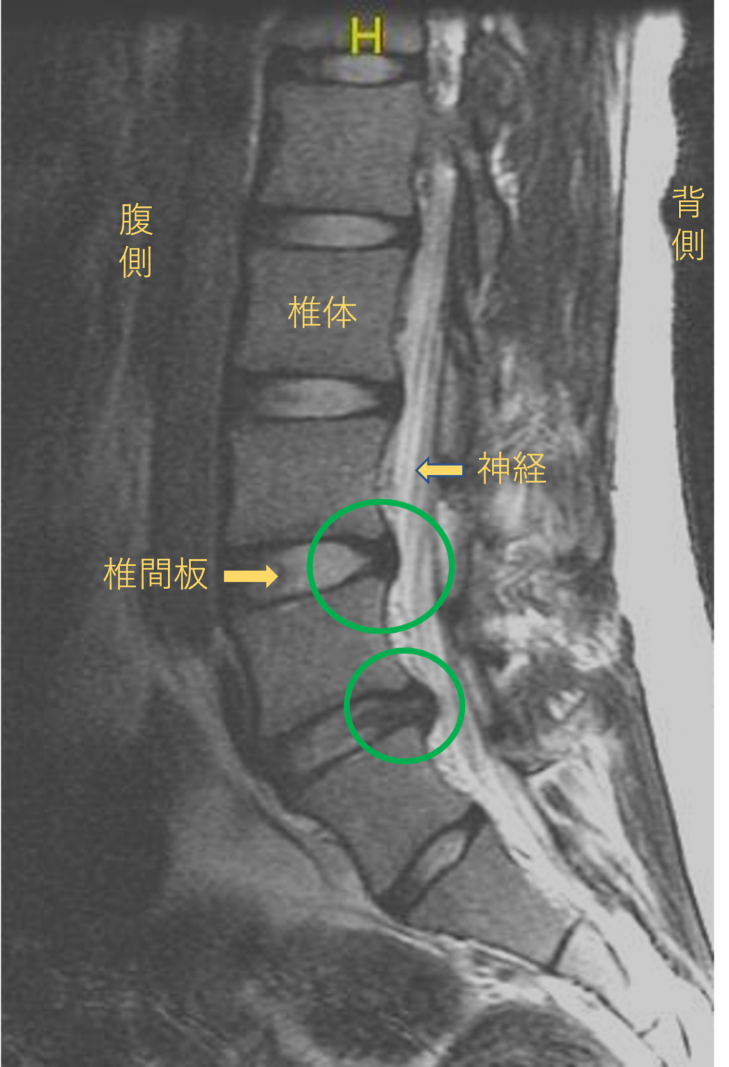 【PLDD法】8か月前から左腰部から左太ももの痛み、しびれがある10代女性【治療実績】 | 医療あれこれ日記 | 椎間板ヘルニアのレーザー治療 PLDD専門クリニック 伊東くりにっく