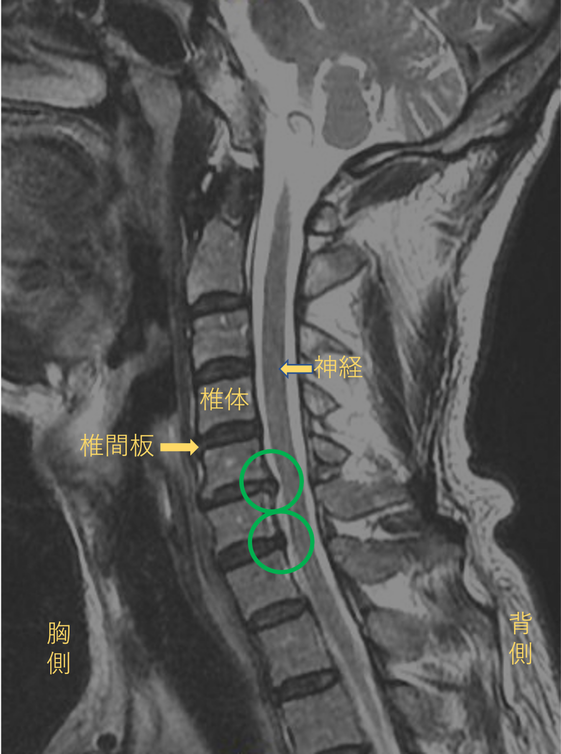 【PLDD法】2週間前から左上肢の痛み、しびれがある70代男性【治療実績】 | 医療あれこれ日記 | 椎間板ヘルニアのレーザー治療 PLDD専門クリニック 伊東くりにっく