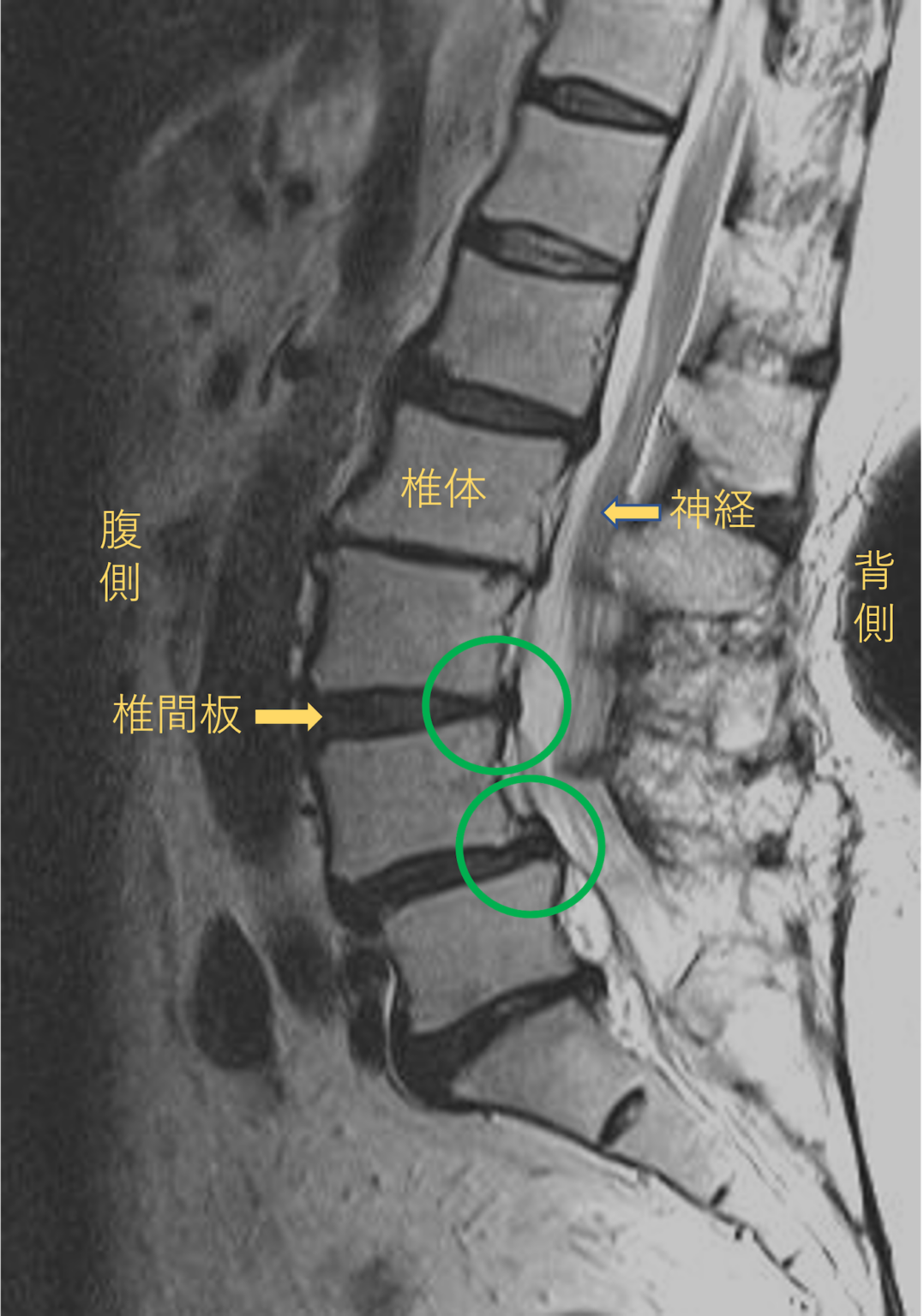 【PLDD法】腰痛、右下肢痛がある70代女性【治療実績】 | 医療あれこれ日記 | 椎間板ヘルニアのレーザー治療 PLDD専門クリニック 伊東くりにっく