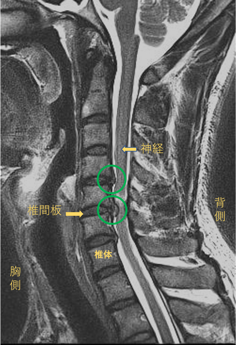 【PLDD法】両手、下半身のしびれがある40代男性【治療実績】 | 医療あれこれ日記 | 椎間板ヘルニアのレーザー治療 PLDD専門クリニック 伊東くりにっく