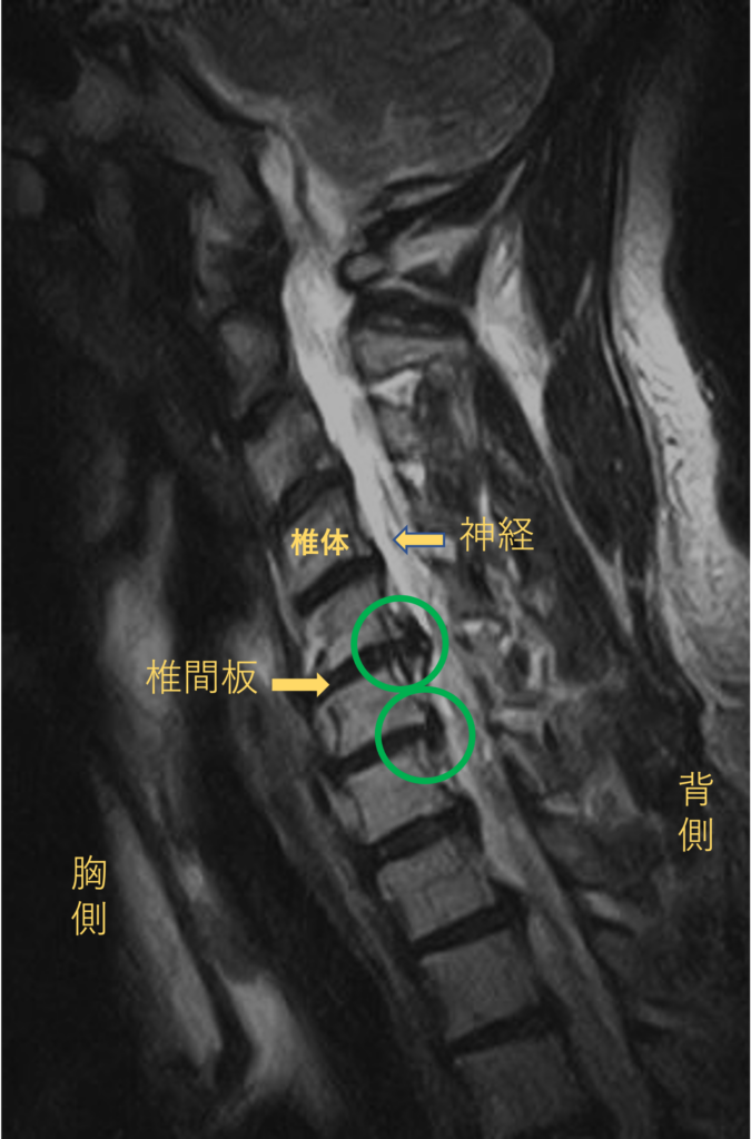 【PLDD法】2年前から両手のしびれがある40代男性【治療実績】 | 医療あれこれ日記 | 椎間板ヘルニアのレーザー治療 PLDD専門クリニック 伊東くりにっく