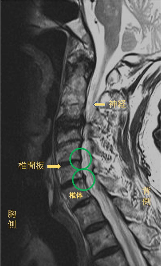 【PLDD法】両上肢のしびれがある80代男性【治療実績】 | 医療あれこれ日記 | 椎間板ヘルニアのレーザー治療 PLDD専門クリニック 伊東くりにっく