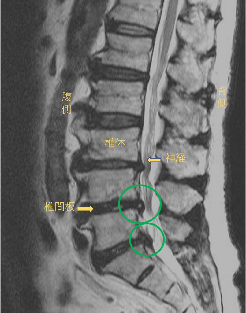 【PLDD法】1年前から両下肢のしびれがある70代男性【治療実績】 | 医療あれこれ日記 | 椎間板ヘルニアのレーザー治療 PLDD専門クリニック 伊東くりにっく