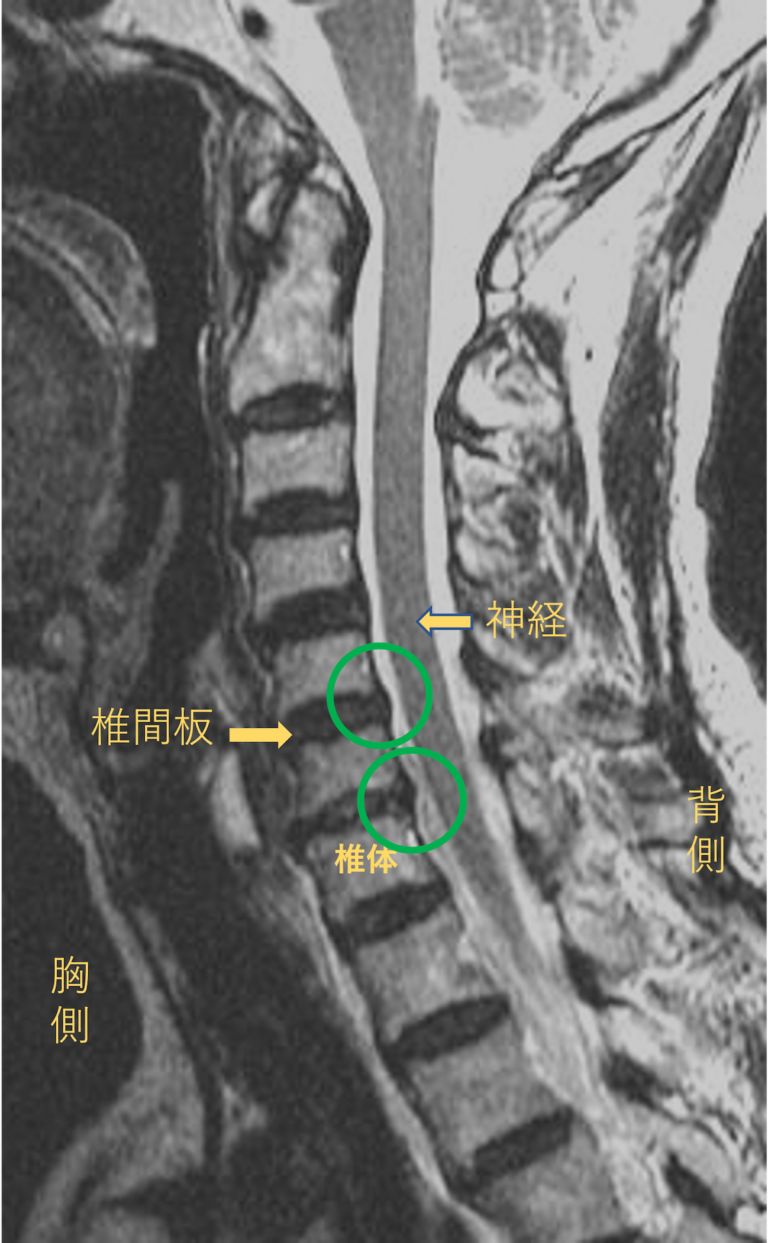 【PLDD法】数年前から首から肩、背中の痛みがある70代女性【治療実績】 | 医療あれこれ日記 | 椎間板ヘルニアのレーザー治療 PLDD専門クリニック 伊東くりにっく