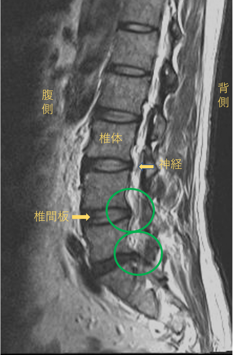 【PLDD法】2か月前から左下肢のしびれがある60代男性【治療実績】 | 医療あれこれ日記 | 椎間板ヘルニアのレーザー治療 PLDD専門クリニック 伊東くりにっく