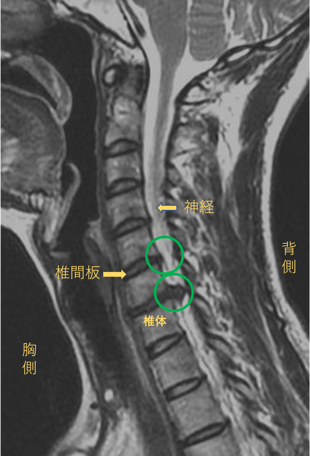 【PLDD法】4か月前から頚部痛、右上肢の痛み、しびれがある40代女性【治療実績】 | 医療あれこれ日記 | 椎間板ヘルニアのレーザー治療 PLDD専門クリニック 伊東くりにっく