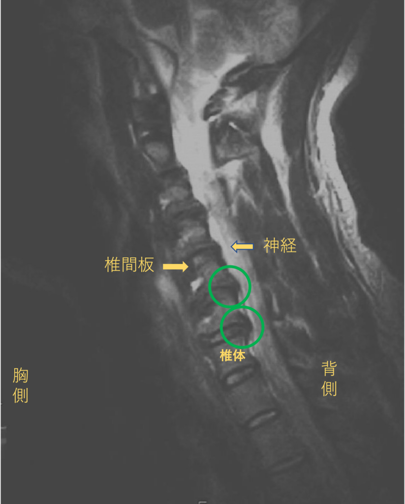 【PLDD法】4か月前から両肩の痛み、両手のしびれがある40代男性【治療実績】 | 医療あれこれ日記 | 椎間板ヘルニアのレーザー治療 PLDD専門クリニック 伊東くりにっく