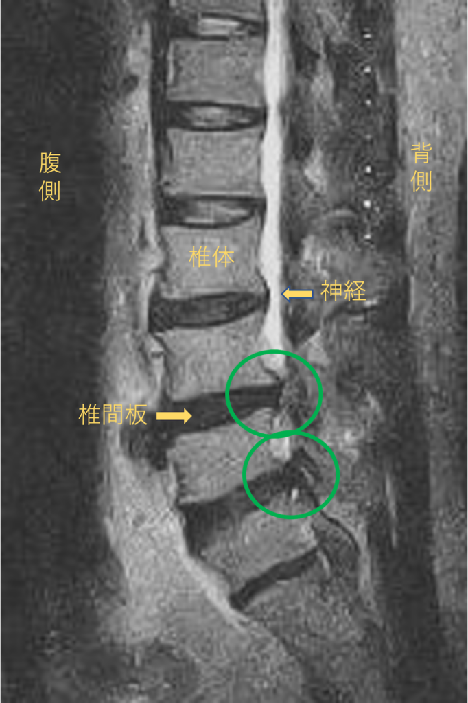 【PLDD法】腰痛、右下肢の痛み、しびれがある40代男性【治療実績】 | 医療あれこれ日記 | 椎間板ヘルニアのレーザー治療 PLDD専門クリニック 伊東くりにっく