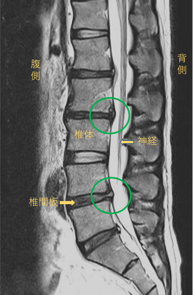 【PLDD法】1年前から腰痛を繰り返している30代男性【治療実績】 | 医療あれこれ日記 | 椎間板ヘルニアのレーザー治療 PLDD専門クリニック 伊東くりにっく