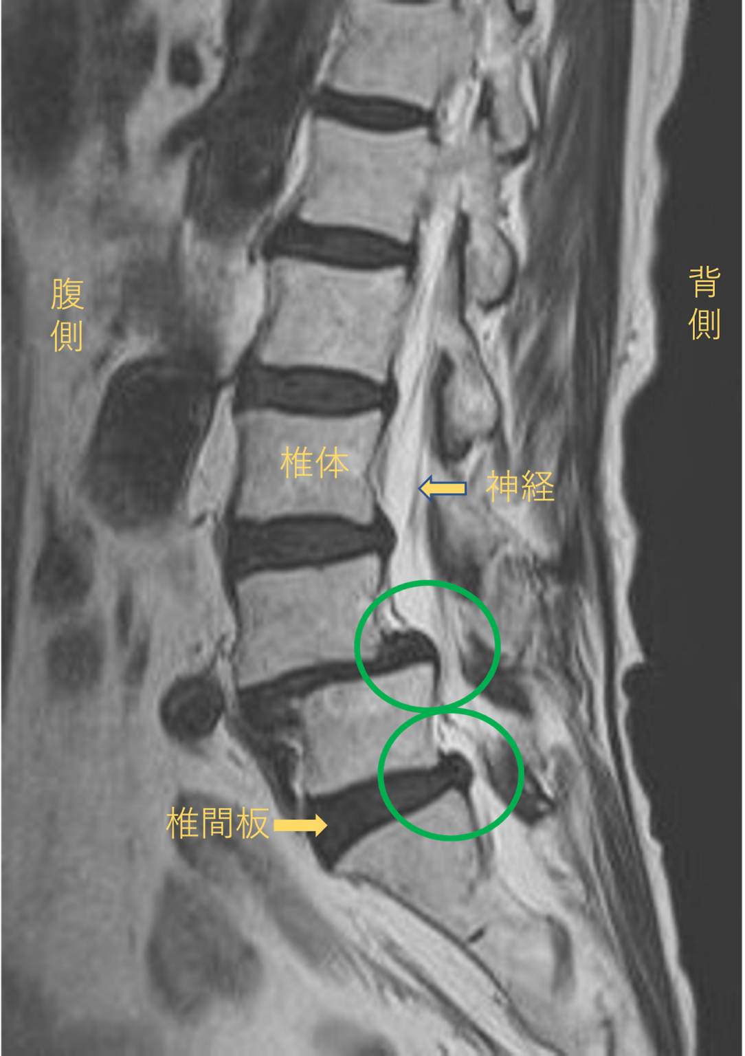 【PLDD法】7年前から腰痛、臀部痛がある70代女性【治療実績】 | 医療あれこれ日記 | 椎間板ヘルニアのレーザー治療 PLDD専門クリニック 伊東くりにっく