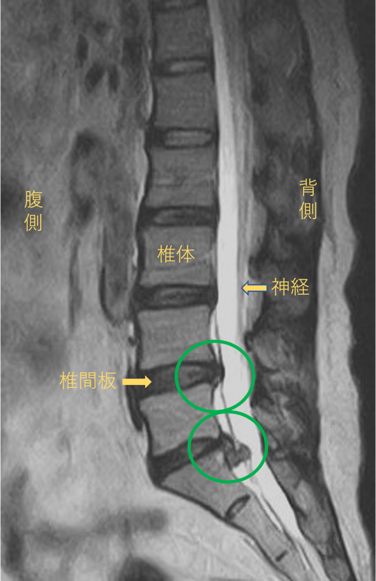 【PLDD法】5か月前から右臀部から右下肢の痛み、しびれがある40代女性【治療実績】 | 医療あれこれ日記 | 椎間板ヘルニアのレーザー治療 PLDD専門クリニック 伊東くりにっく