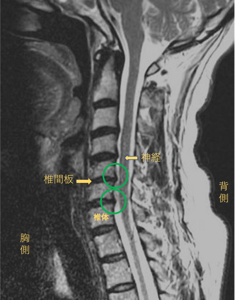 【PLDD法】1年前から左肩から左上腕の痛み、しびれがある50代男性【治療実績】 | 医療あれこれ日記 | 椎間板ヘルニアのレーザー治療 PLDD専門クリニック 伊東くりにっく