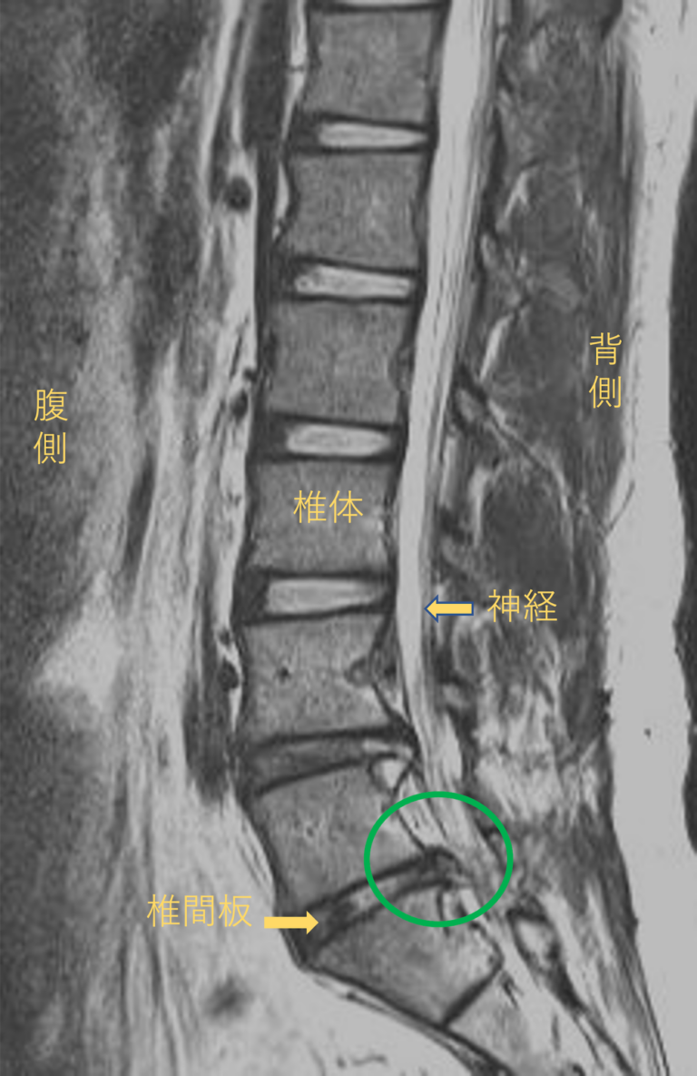 【PLDD法】右臀部から右下肢の痛みがある20代男性【治療実績】 | 医療あれこれ日記 | 椎間板ヘルニアのレーザー治療 PLDD専門 ...