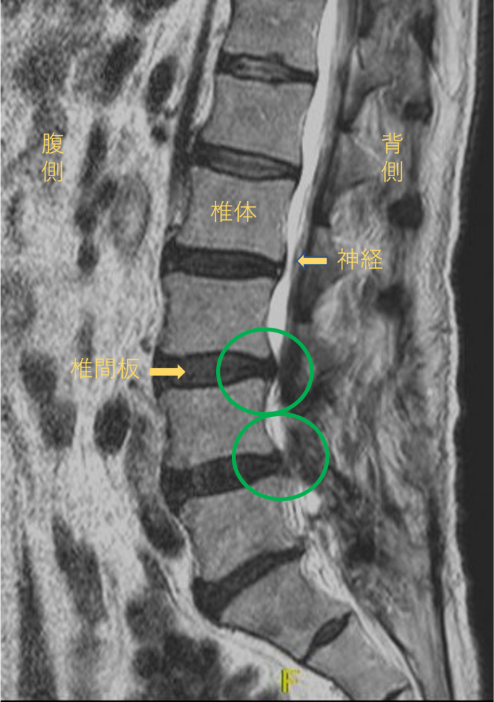 【PLDD法】9年前から右臀部から右下肢の痛み、しびれがある70代男性【治療実績】 | 医療あれこれ日記 | 椎間板ヘルニアのレーザー治療 PLDD専門クリニック 伊東くりにっく