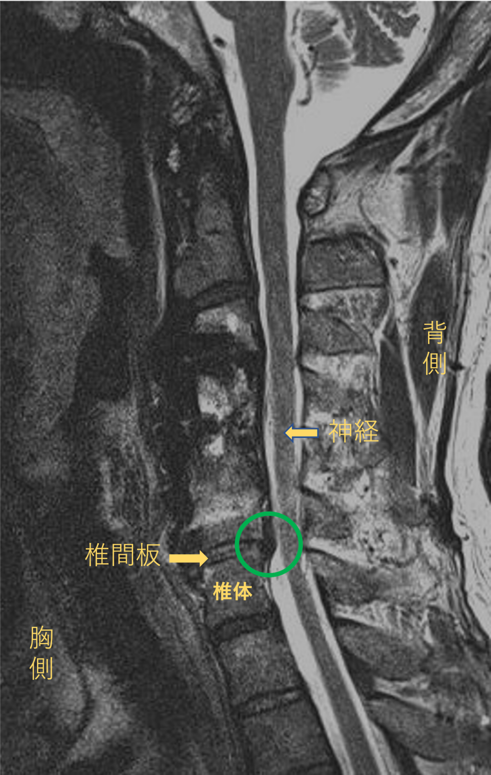 【PLDD法】5年前より右手のしびれがある50代男性【治療実績】 | 医療あれこれ日記 | 椎間板ヘルニアのレーザー治療 PLDD専門クリニック 伊東くりにっく