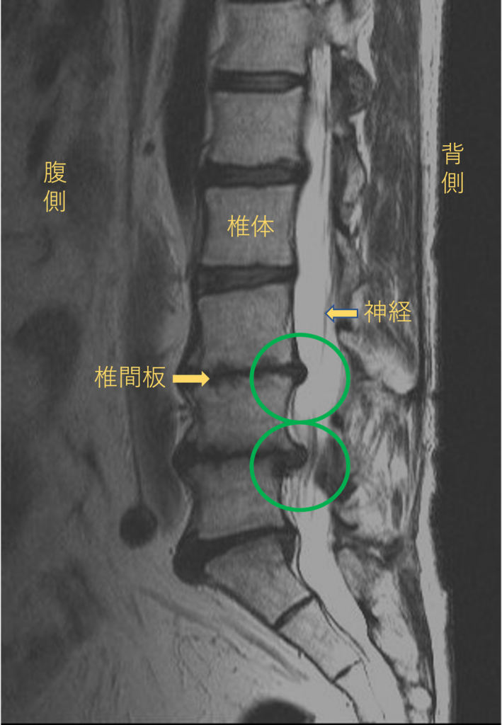 【PLDD法】10か月前から両下肢の痛み、しびれがある60代男性【治療実績】 | 医療あれこれ日記 | 椎間板ヘルニアのレーザー治療 PLDD専門クリニック 伊東くりにっく