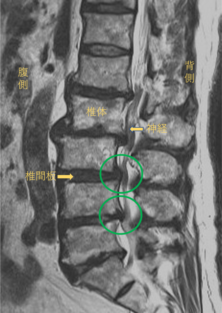 【PLDD法】腰痛、左下肢の痛みがある60代男性【治療実績】 | 医療あれこれ日記 | 椎間板ヘルニアのレーザー治療 PLDD専門クリニック 伊東くりにっく