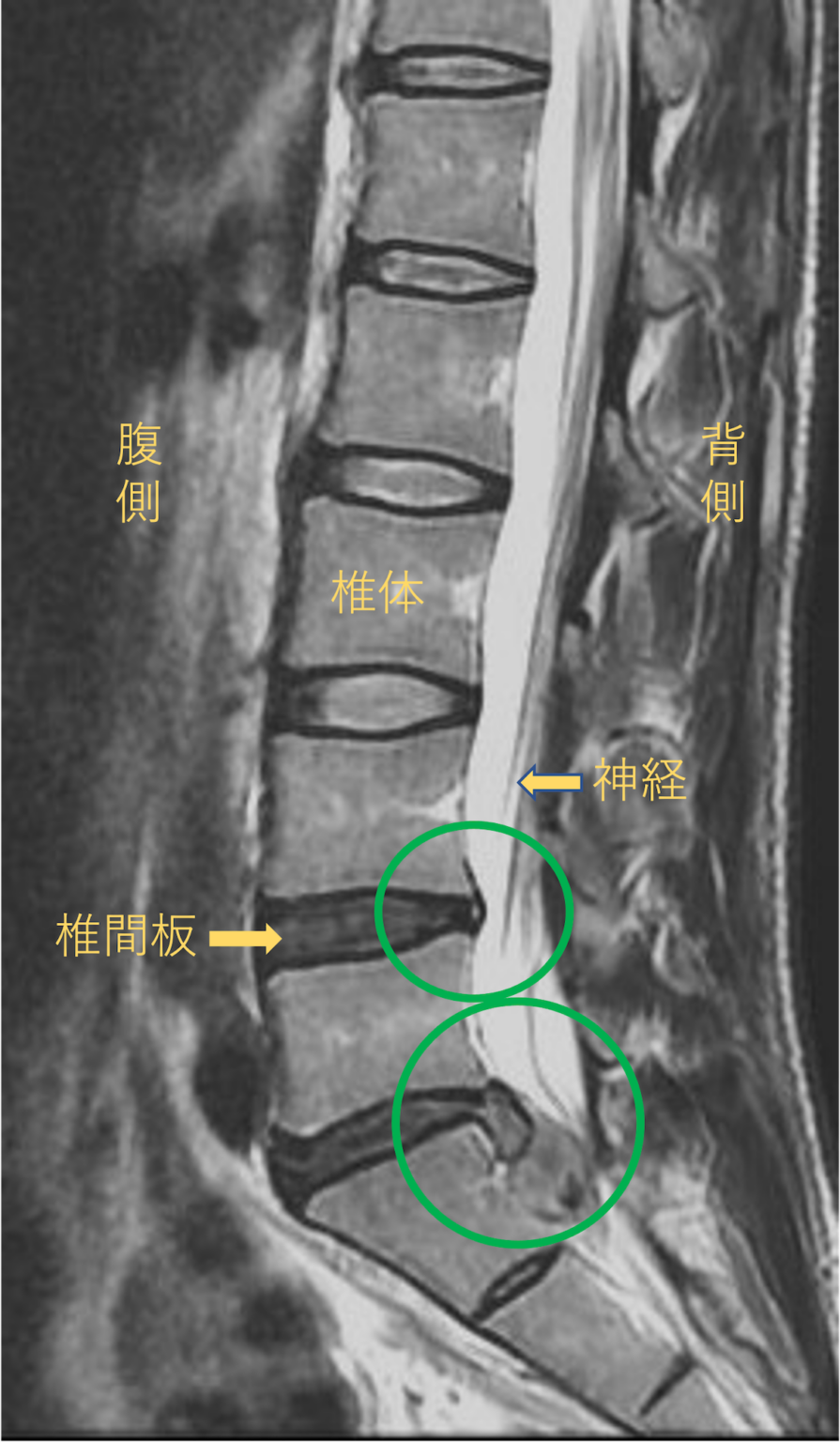 【PLDD法】2か月前から腰痛、右下肢の痛み、しびれがある40代男性【治療実績】 | 医療あれこれ日記 | 椎間板ヘルニアのレーザー治療 PLDD専門クリニック 伊東くりにっく