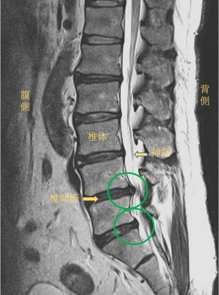 【PLDD法】腰の痛みがある40代男性【治療実績】 | 医療あれこれ日記 | 椎間板ヘルニアのレーザー治療 PLDD専門クリニック 伊東くりにっく