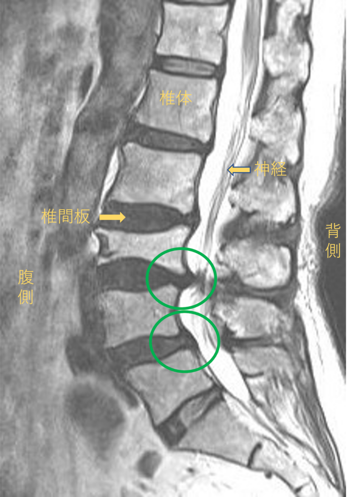 【PLDD法】腰痛がある60代女性【治療実績】 | 医療あれこれ日記 | 椎間板ヘルニアのレーザー治療 PLDD専門クリニック 伊東くりにっく