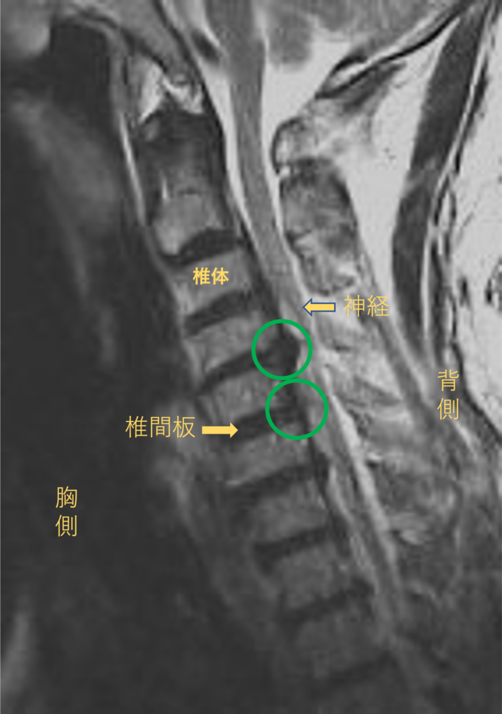 【PLDD法】10年前から左上肢のしびれがある60代男性【治療実績】 | 医療あれこれ日記 | 椎間板ヘルニアのレーザー治療 PLDD専門クリニック 伊東くりにっく