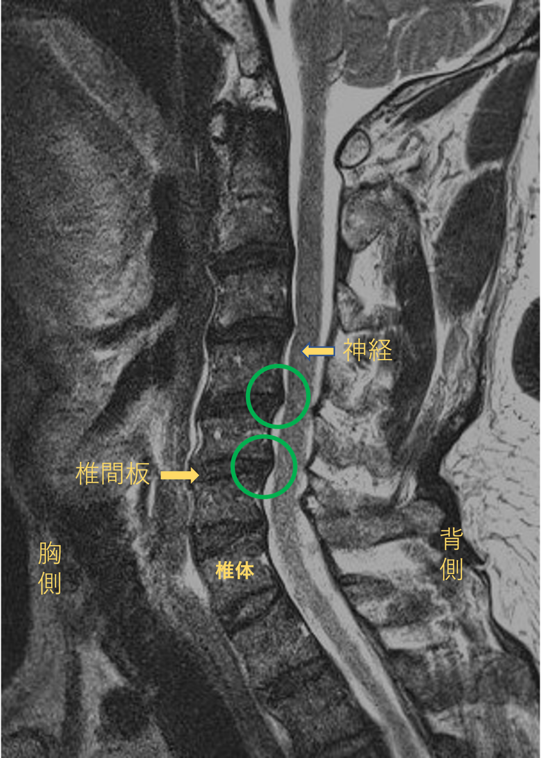 【PLDD法】1年前から首の痛み、手足のしびれがある60代男性【治療実績】 | 医療あれこれ日記 | 椎間板ヘルニアのレーザー治療 PLDD専門クリニック 伊東くりにっく