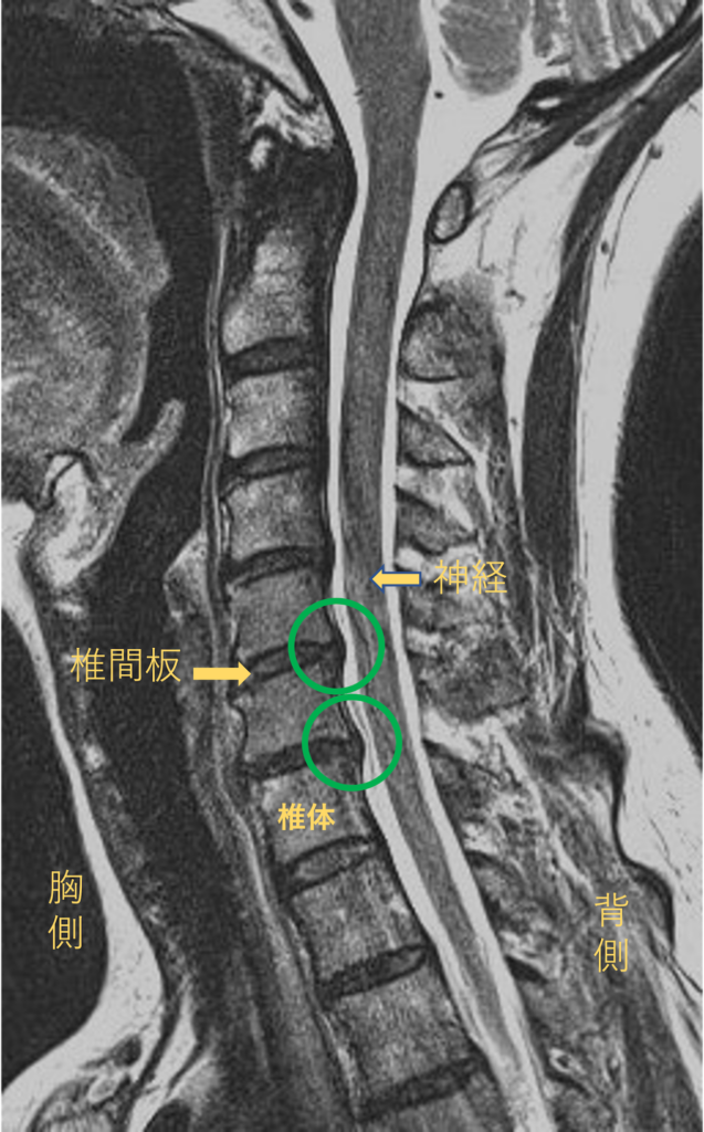 【PLDD法】2年前から頚部痛があり、右上肢に痛み、しびれがある50代女性【治療実績】 | 医療あれこれ日記 | 椎間板ヘルニアのレーザー治療 PLDD専門クリニック 伊東くりにっく