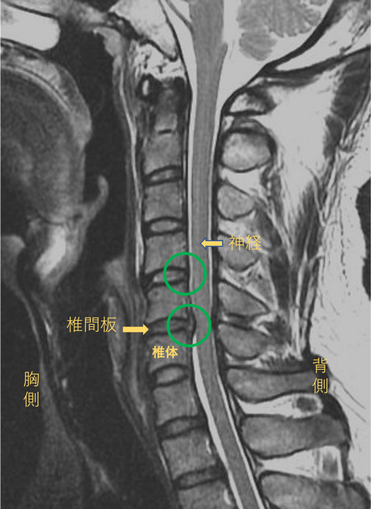 【PLDD法】3か月前から左手のしびれがある30代男性【治療実績】 | 医療あれこれ日記 | 椎間板ヘルニアのレーザー治療 PLDD専門クリニック 伊東くりにっく