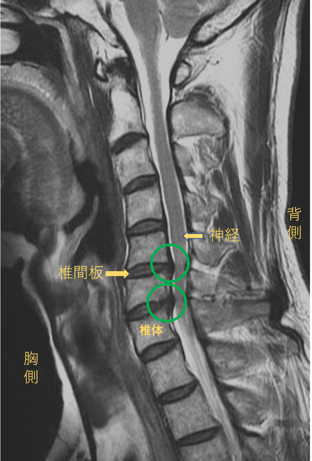 【PLDD法】2年前から両上肢の痛み、しびれがある40代男性【治療実績】 | 医療あれこれ日記 | 椎間板ヘルニアのレーザー治療 PLDD専門クリニック 伊東くりにっく