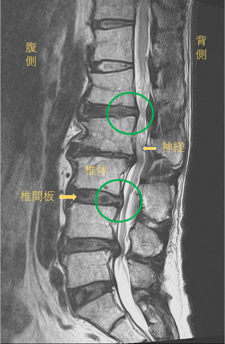 【PLDD法】腰痛、両下肢のしびれががある60代男性【治療実績】 | 医療あれこれ日記 | 椎間板ヘルニアのレーザー治療 PLDD専門クリニック 伊東くりにっく