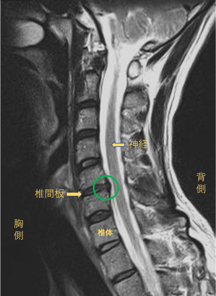 【PLDD法】4か月前から右上肢の痛み、握力低下がある30代男性【治療実績】 | 医療あれこれ日記 | 椎間板ヘルニアのレーザー治療 PLDD専門クリニック 伊東くりにっく