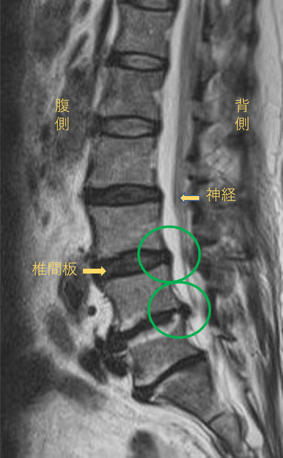 【PLDD法】5か月前から腰痛、右下肢痛がある60代女性【治療実績】 | 医療あれこれ日記 | 椎間板ヘルニアのレーザー治療 PLDD専門クリニック 伊東くりにっく