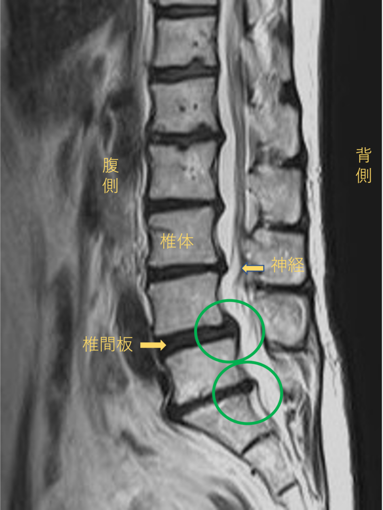 【PLDD法】左下肢の痛み、しびれがある60代女性【治療実績】 | 医療あれこれ日記 | 椎間板ヘルニアのレーザー治療 PLDD専門クリニック 伊東くりにっく