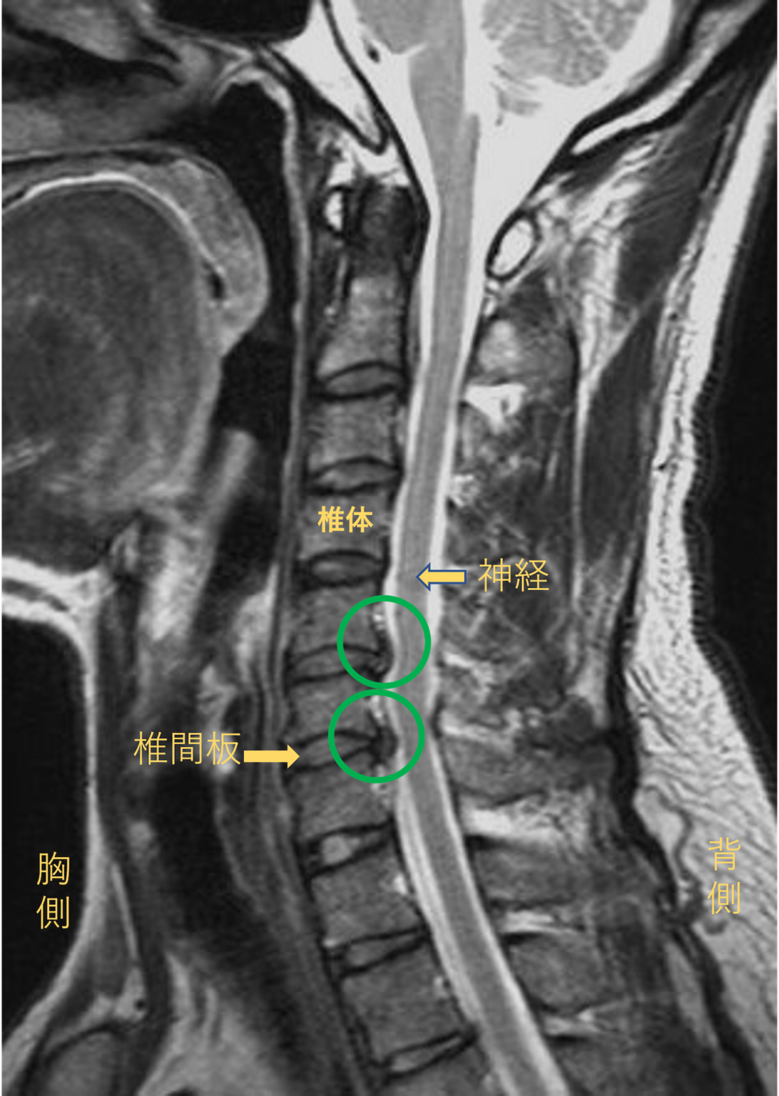 【PLDD法】1年前から両上肢の痛み、しびれがある40代男性【治療実績】 | 医療あれこれ日記 | 椎間板ヘルニアのレーザー治療 PLDD専門クリニック 伊東くりにっく