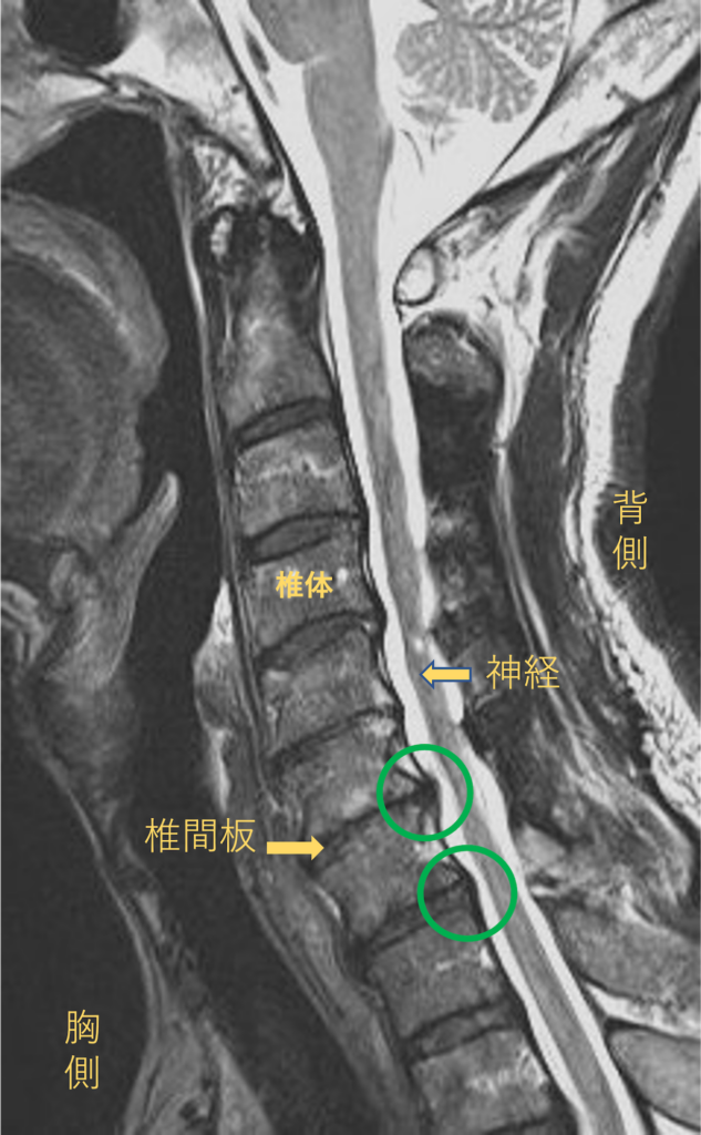 【PLDD法】右上肢の痛みがある60代男性【治療実績】 | 医療あれこれ日記 | 椎間板ヘルニアのレーザー治療 PLDD専門クリニック 伊東くりにっく
