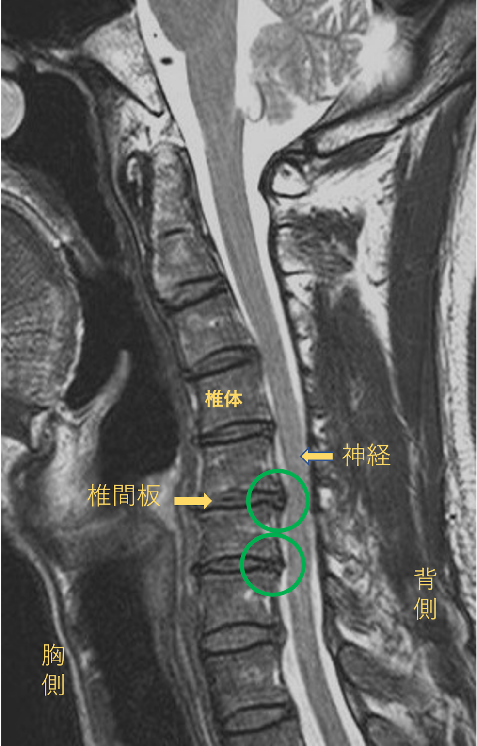 【PLDD法】2年前から左上肢の痛み、しびれがある50代男性【治療実績】 | 医療あれこれ日記 | 椎間板ヘルニアのレーザー治療 PLDD専門クリニック 伊東くりにっく