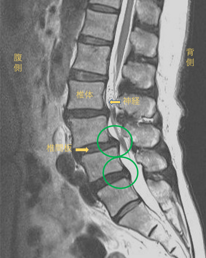 【PLDD法】1年前から両下肢の痛み、しびれがある60代女性【治療実績】 | 医療あれこれ日記 | 椎間板ヘルニアのレーザー治療 PLDD専門クリニック 伊東くりにっく