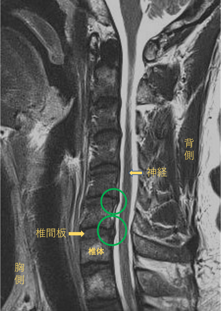 【PLDD法】2か月前から左肩の痛み、左上肢のしびれがある40代男性【治療実績】 | 医療あれこれ日記 | 椎間板ヘルニアのレーザー治療 PLDD専門クリニック 伊東くりにっく