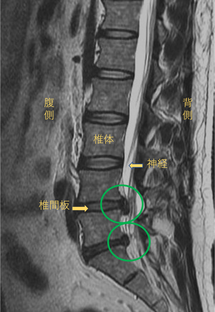 【PLDD法】4か月前から右臀部から右下肢の痛みがある40代男性【治療実績】 | 医療あれこれ日記 | 椎間板ヘルニアのレーザー治療 PLDD専門クリニック 伊東くりにっく