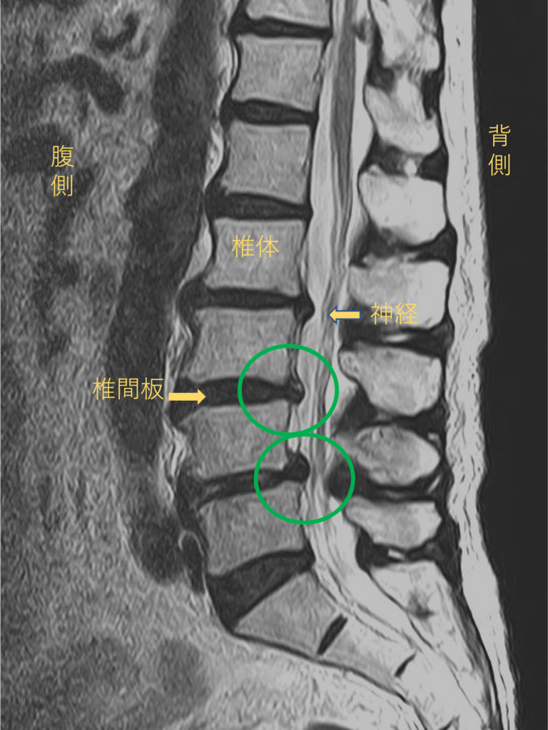 【PLDD法】3か月前から左下肢の痛み、しびれがある80代女性【治療実績】 | 医療あれこれ日記 | 椎間板ヘルニアのレーザー治療 PLDD専門クリニック 伊東くりにっく