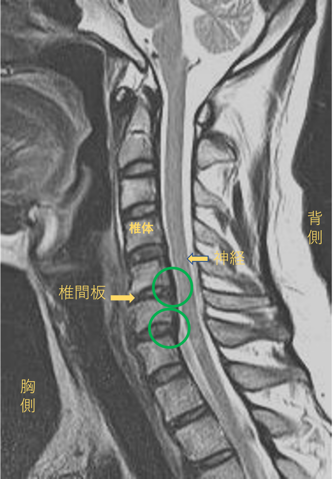 【PLDD法】5か月前から右上肢のしびれがある40代男性【治療実績】 | 医療あれこれ日記 | 椎間板ヘルニアのレーザー治療 PLDD専門クリニック 伊東くりにっく