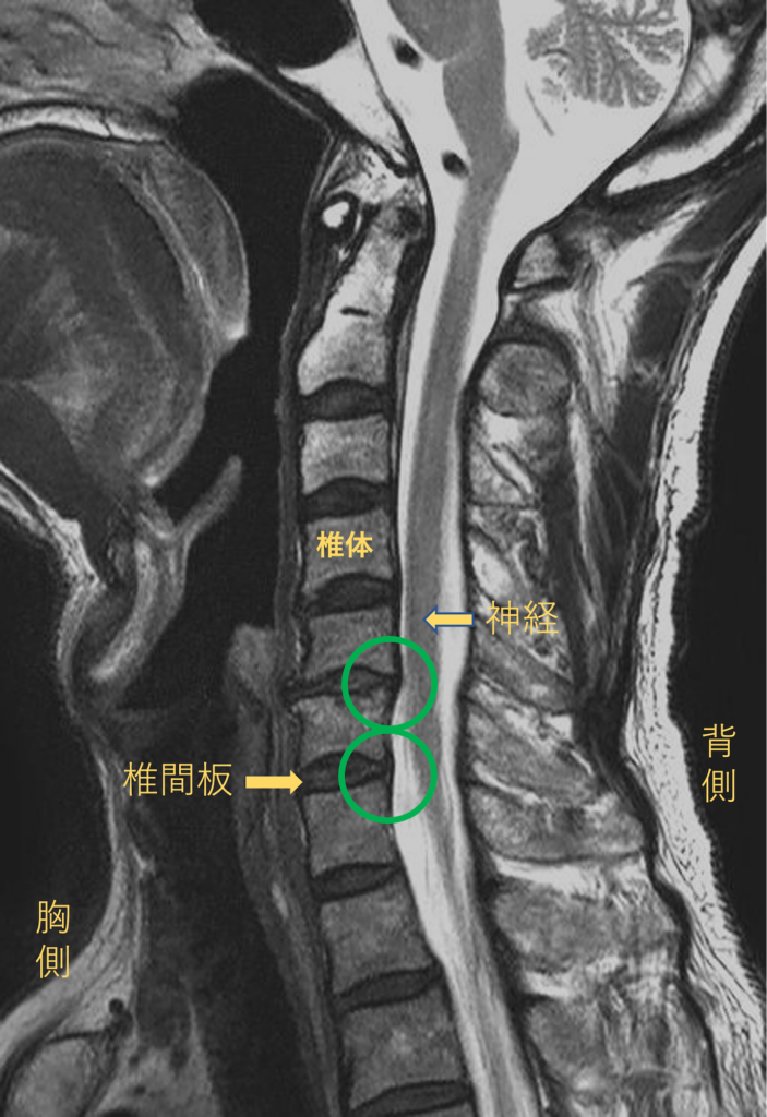 【PLDD法】1年前から首から肩の痛み、両手のしびれがある60代男性【治療実績】 | 医療あれこれ日記 | 椎間板ヘルニアのレーザー治療 PLDD専門クリニック 伊東くりにっく