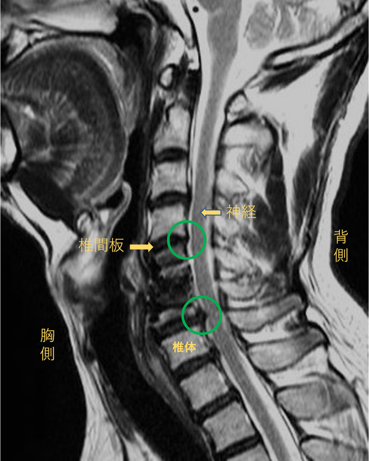 【PLDD法】半年前から左上肢の痛み、しびれがある50代男性【治療実績】 | 医療あれこれ日記 | 椎間板ヘルニアのレーザー治療 PLDD専門クリニック 伊東くりにっく