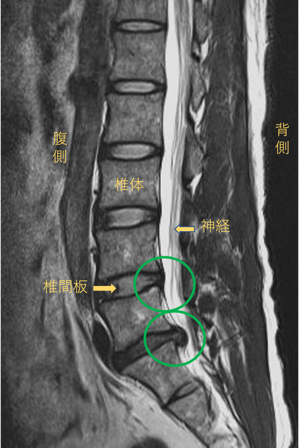 【PLDD法】1年前から腰痛、その後左下肢の痛み、しびれがある40代男性【治療実績】 | 医療あれこれ日記 | 椎間板ヘルニアのレーザー治療 PLDD専門クリニック 伊東くりにっく