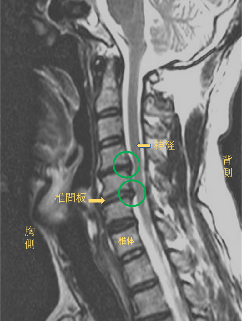 【PLDD法】半年前から頚部痛、左上肢のしびれがある40代男性【治療実績】 | 医療あれこれ日記 | 椎間板ヘルニアのレーザー治療 PLDD専門クリニック 伊東くりにっく
