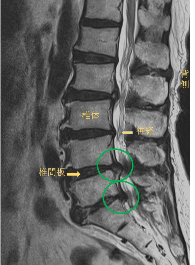 【PLDD法】3か月前から両下肢のしびれがある70代女性【治療実績】 | 医療あれこれ日記 | 椎間板ヘルニアのレーザー治療 PLDD専門 ...