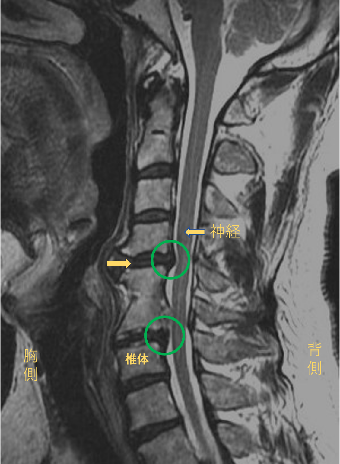 【PLDD法】2か月前から両上肢のしびれがある50代男性【治療実績】 | 医療あれこれ日記 | 椎間板ヘルニアのレーザー治療 PLDD専門クリニック 伊東くりにっく