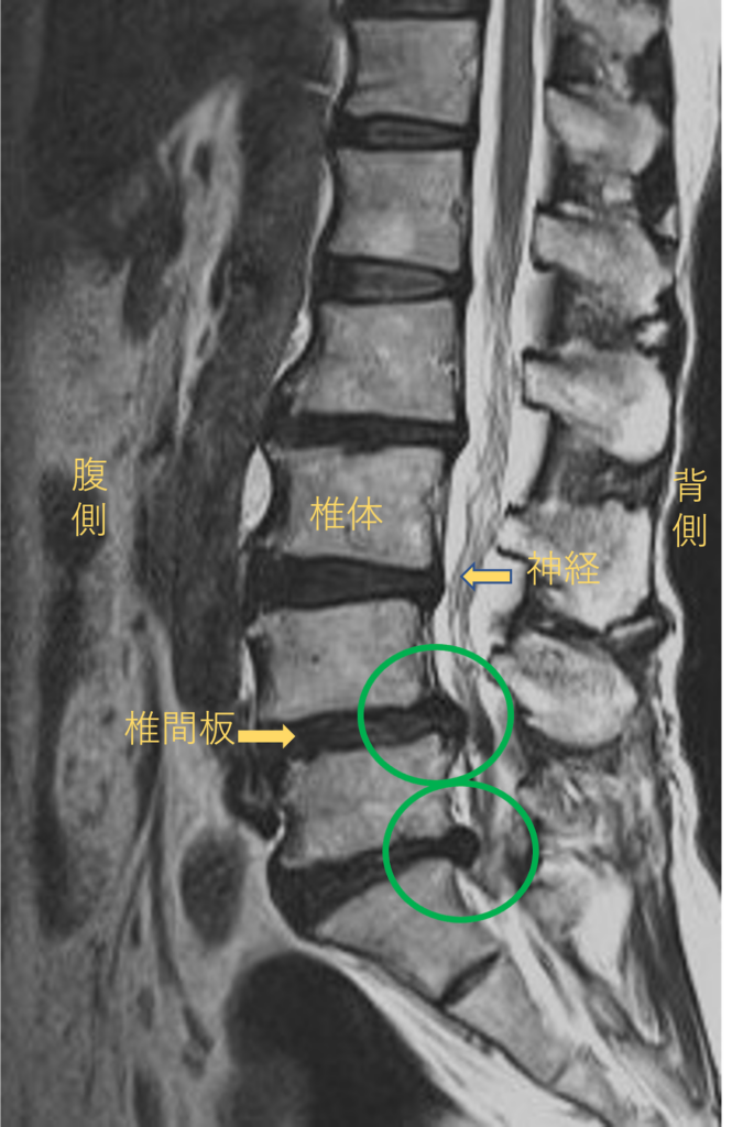 【PLDD法】4か月前から腰痛、右下肢の痛み、しびれがある60代女性【治療実績】 | 医療あれこれ日記 | 椎間板ヘルニアのレーザー治療 PLDD専門クリニック 伊東くりにっく