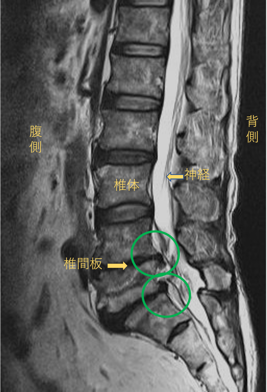 【PLDD法】左臀部から左下肢の痛み、しびれがある60代男性【治療実績】 | 医療あれこれ日記 | 椎間板ヘルニアのレーザー治療 PLDD専門 ...